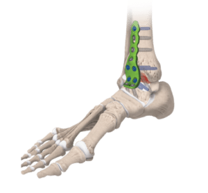 La prothèse de cheville pour traiter l'arthrose. - Dr Nicolas Pinar