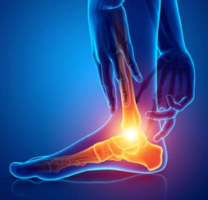 Chirurgie de l'arthrose de cheville - Dr Nicolas Pinar , chirurgien à Paris