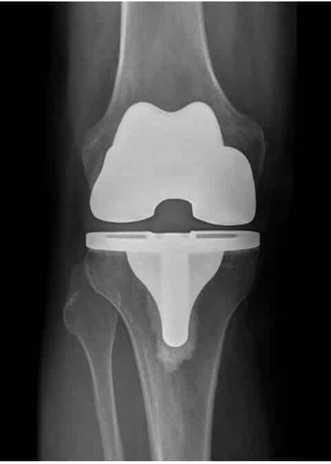 Prothèse du genou pour traiter l'arthrose- Dr Nicolas Pinar