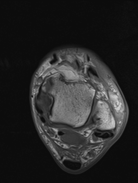 Comment réparer efficacement les tendons fibulaires? - Dr Nicolas Pinar